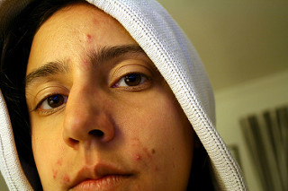 Can Stress Cause Acne? - Anxiety Boss